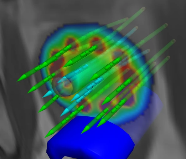Braquiterapia | Varian