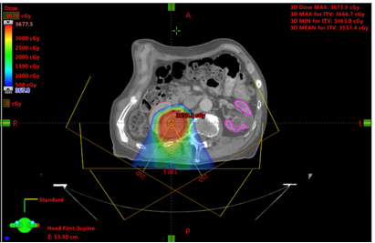 Is Omental Caking Always Cancer